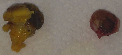 Bumblefoot in chickens, the risks, treatment and prevention - Cluckin